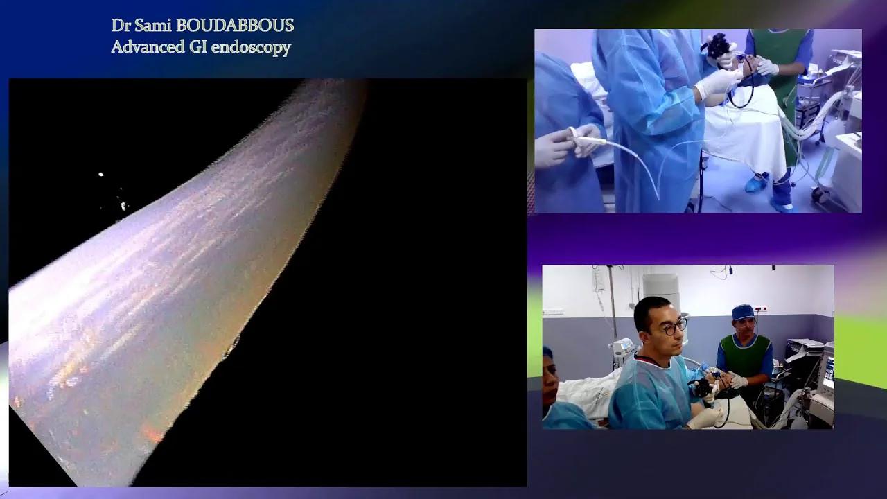 ERCP for acute cholangitis