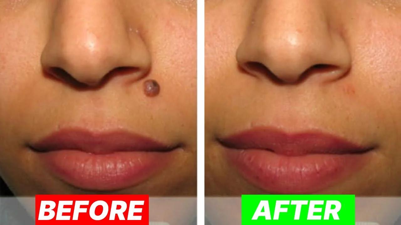 How to Rid Skin Tags Within 24 Hours? 8 Home Remedies to Rid Skin Tags