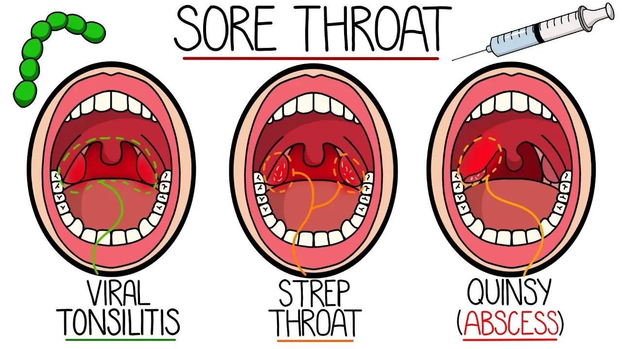 Sore Throat Explained (Including Strep Throat & Peritonsillar Abscess)