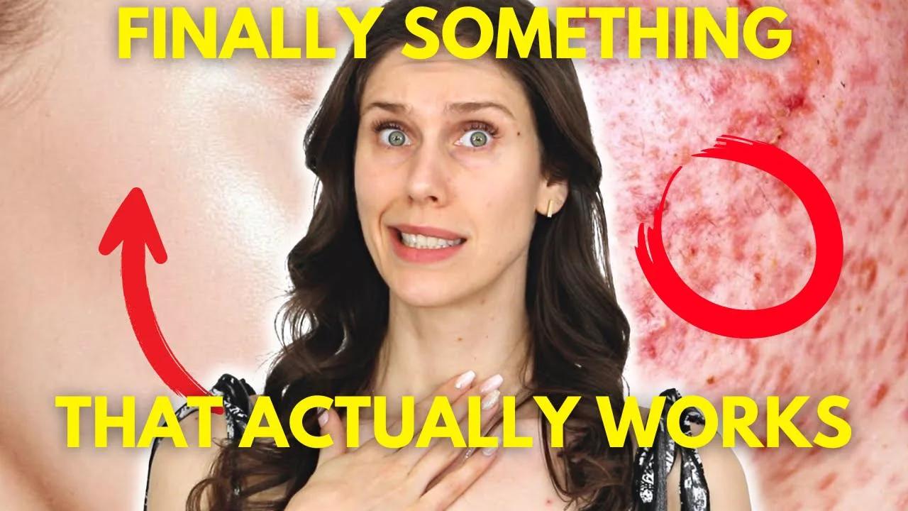 5 Best PIP/PIH Ingredients For Acne Hyperpigmentation & How They Work