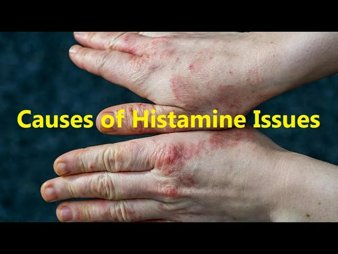 Causes of Histamine Issues