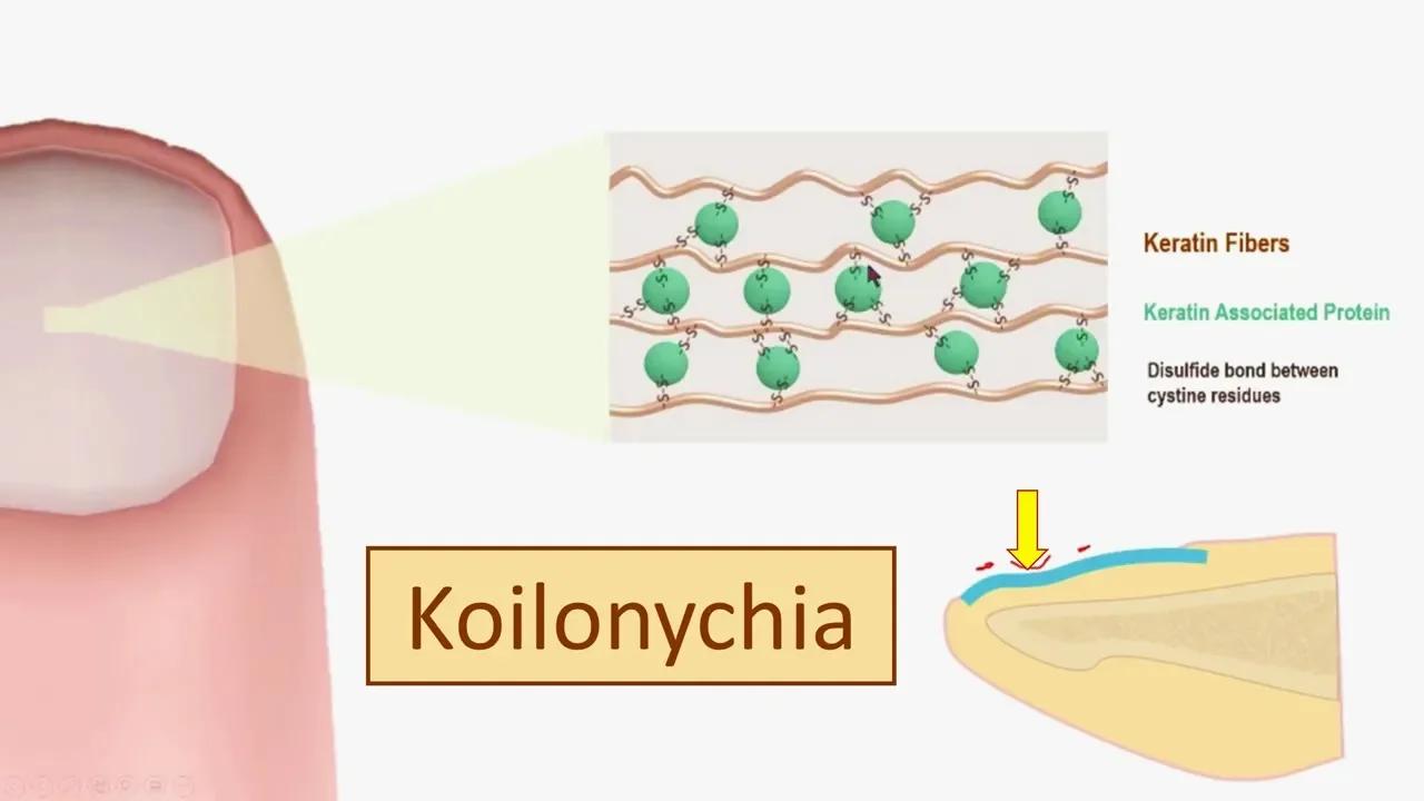 How Koilonychia develops in Iron Deficiency Anemia - Koilonychia (spoon ...