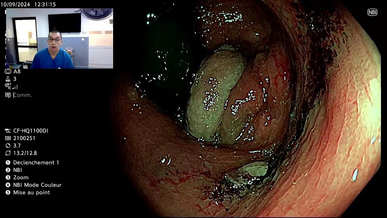 Screening colonoscopy