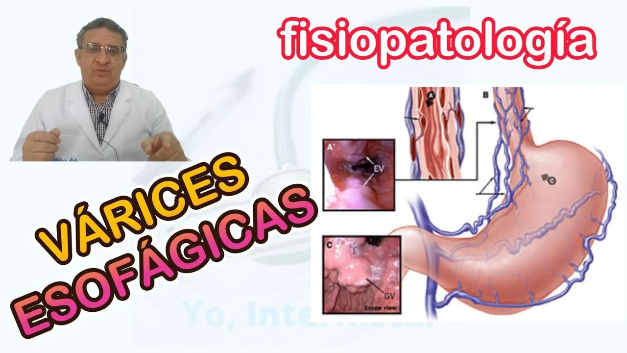 VARICES ESOFAGICAS FISIOPATOLOGIA