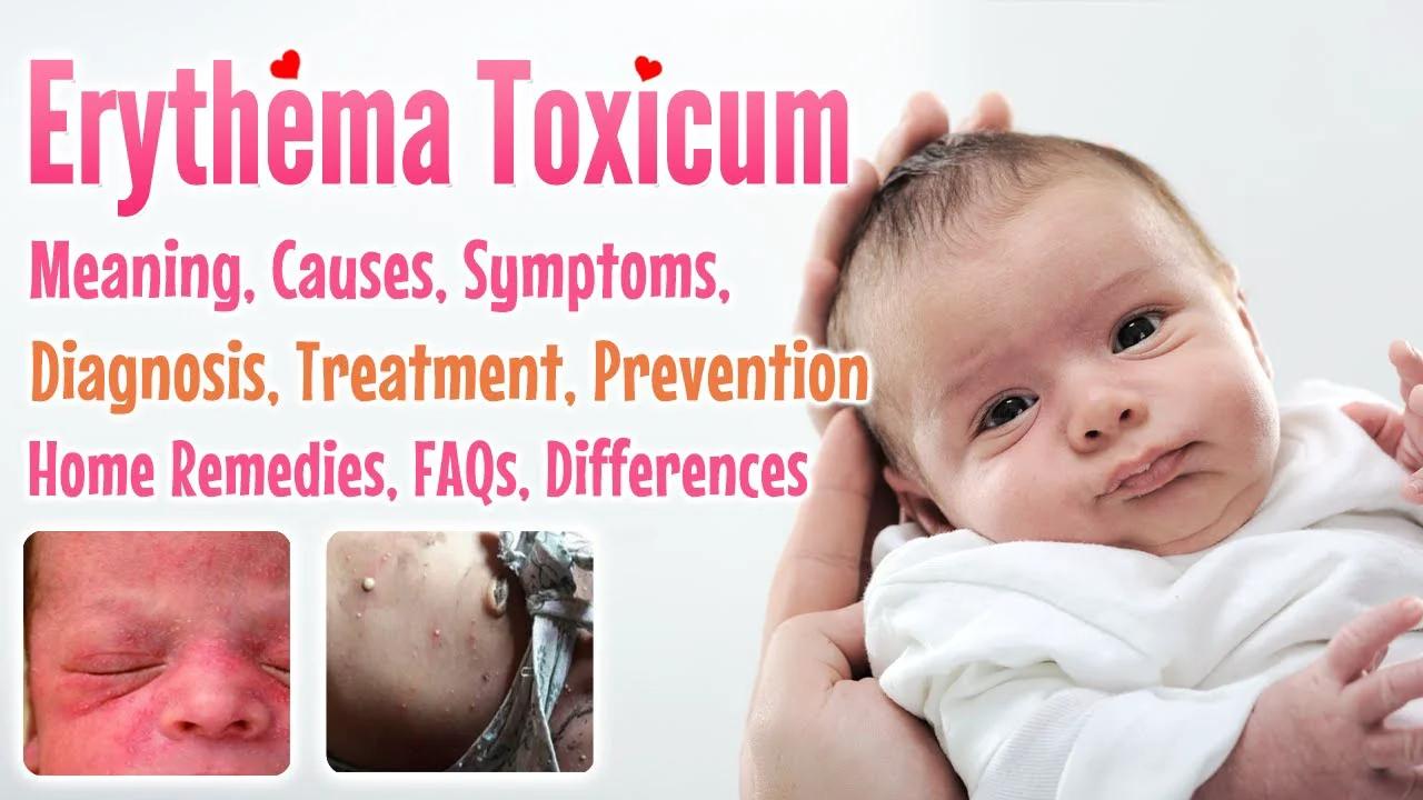 Erythema toxicum overview, causes, sign and symptoms, treatment ...