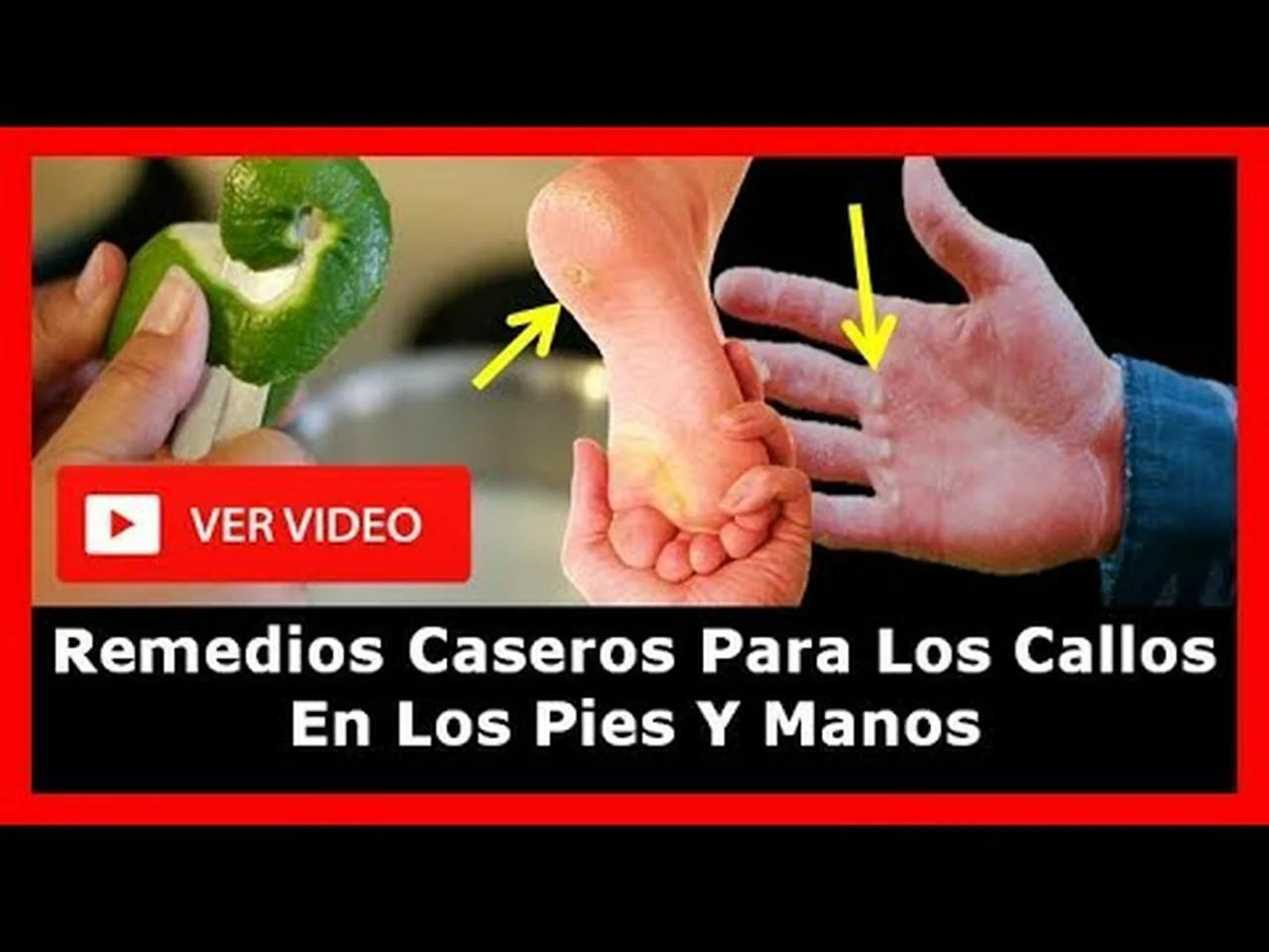 Remedios Caseros Para Los Callos, Como Quitar Los Callos, Callos En Los ...