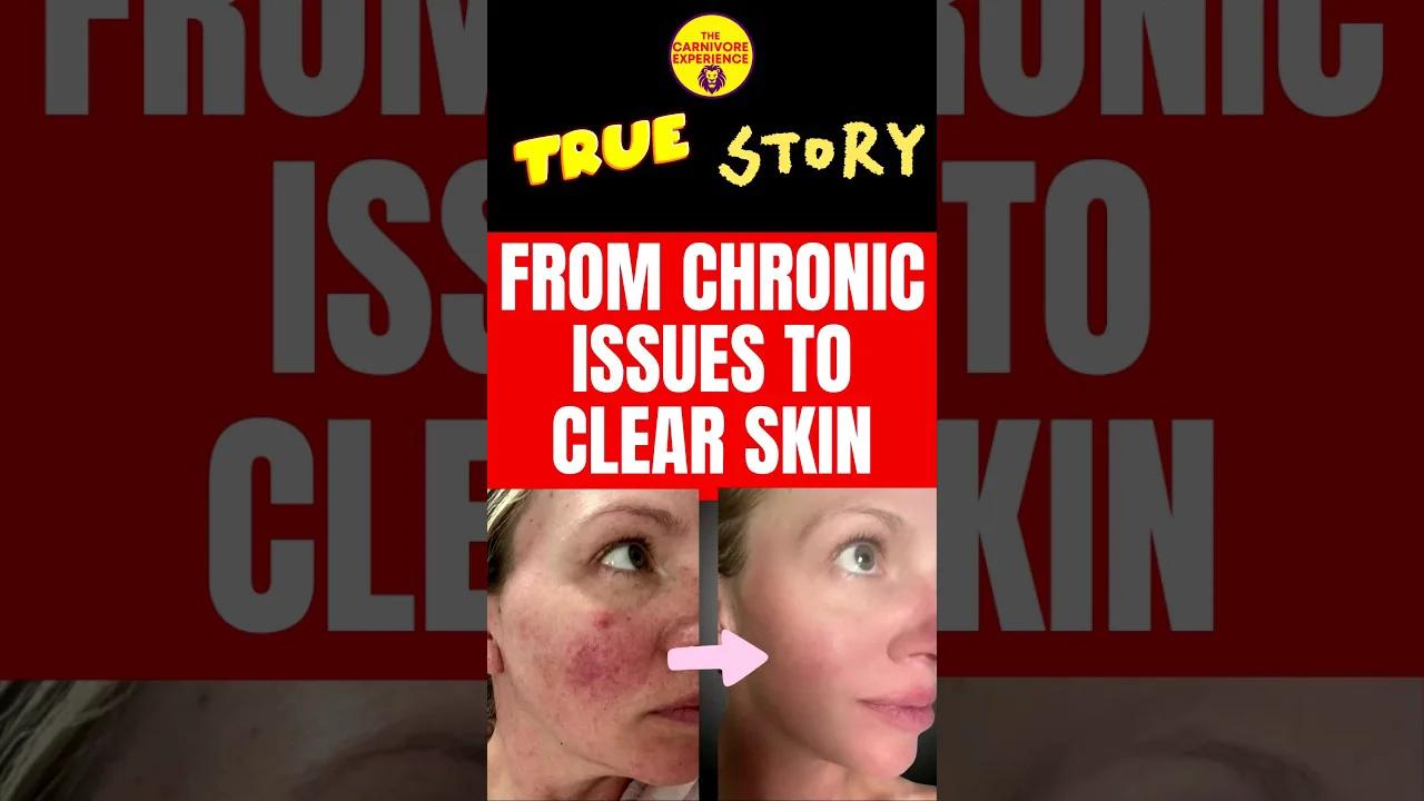 From chronic issues to clear skin #carnivorecoach #acne