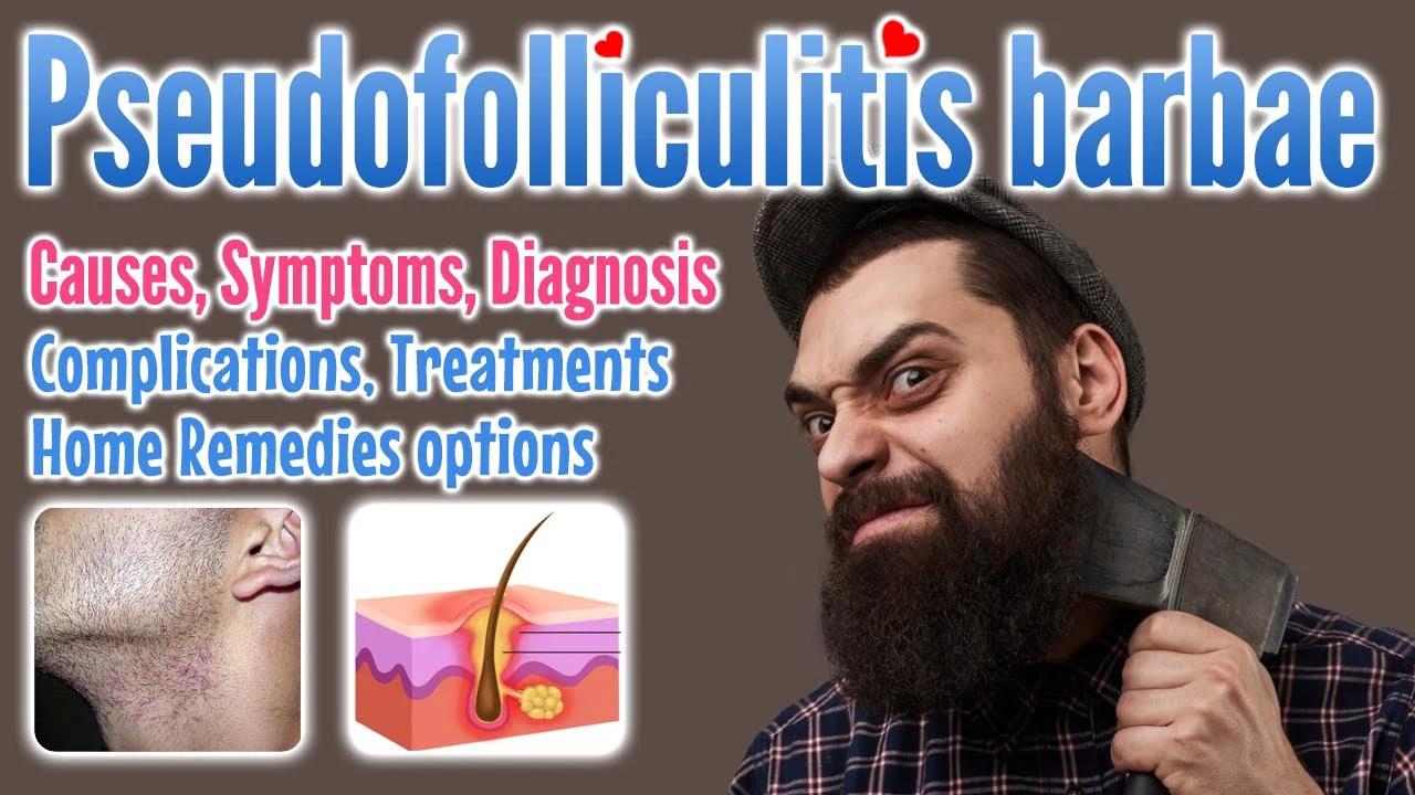 Pseudofolliculitis barbae overview, causes, symptoms, diagnosis ...