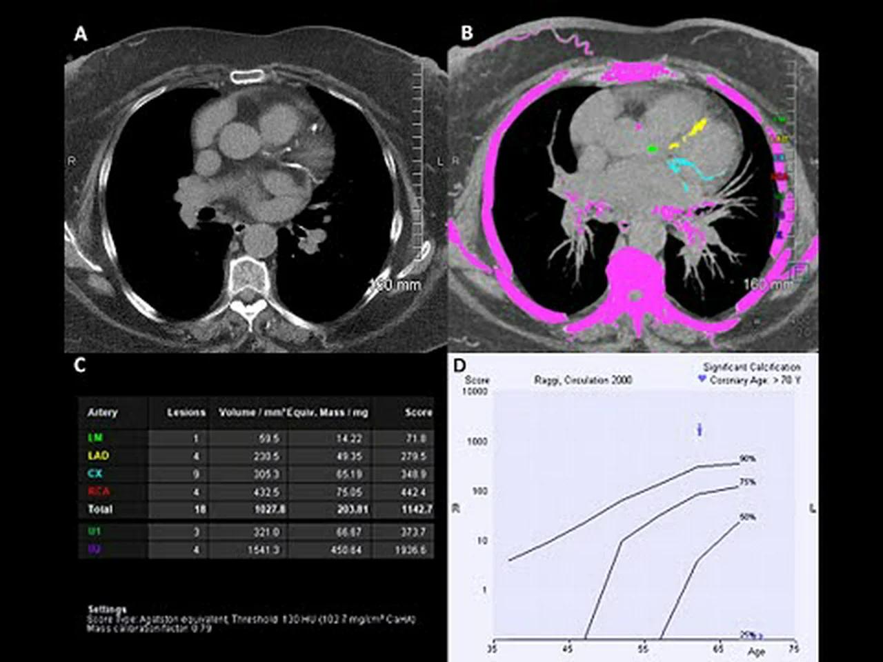 Ep130 A Super-High Calcium Score? How to Deal with It!