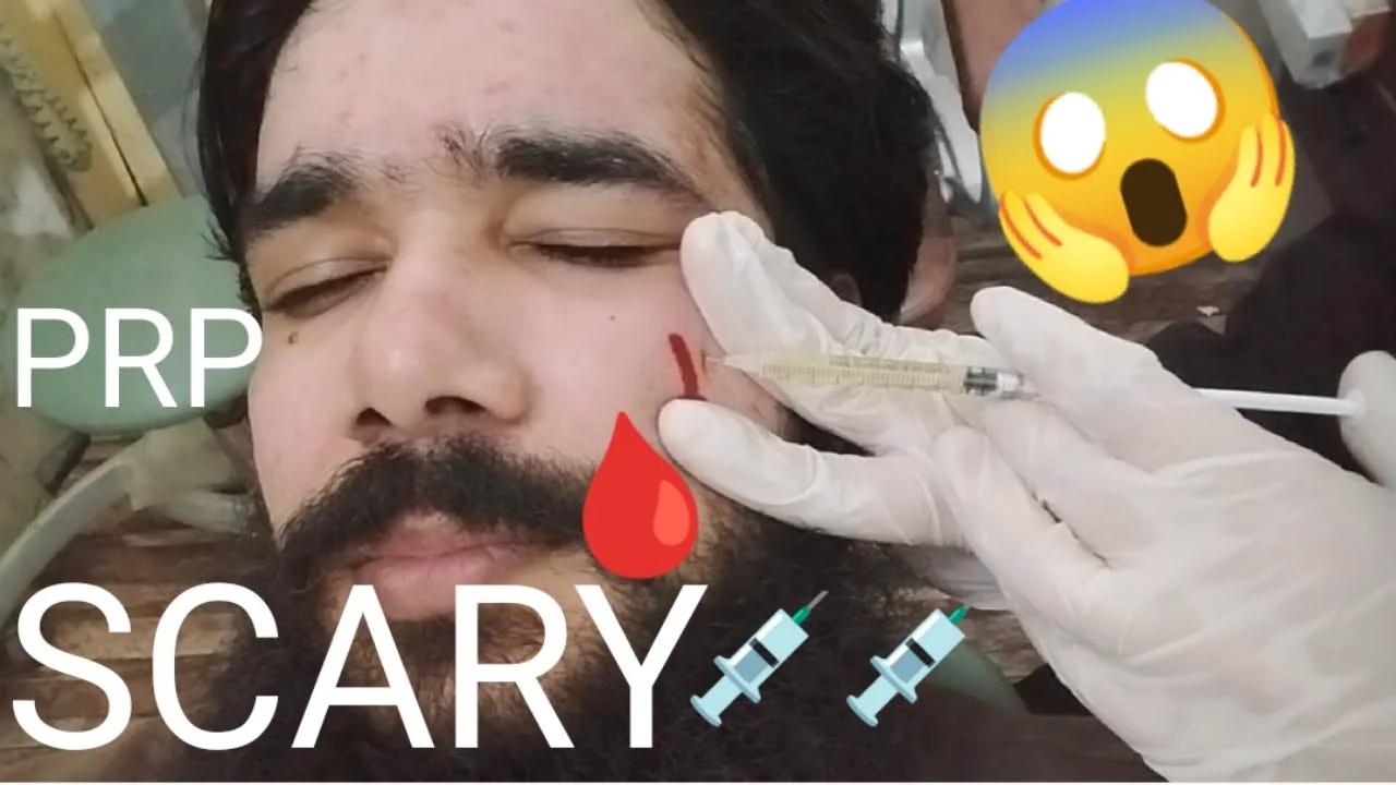 VAMPIRE FACIAL IN PAKISTAN?? Microneedling Prp treatment