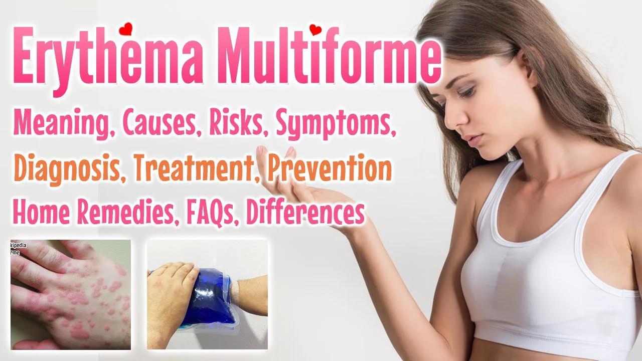Erythema Multiforme Overview, Causes, Risks, Symptoms, Treatment ...