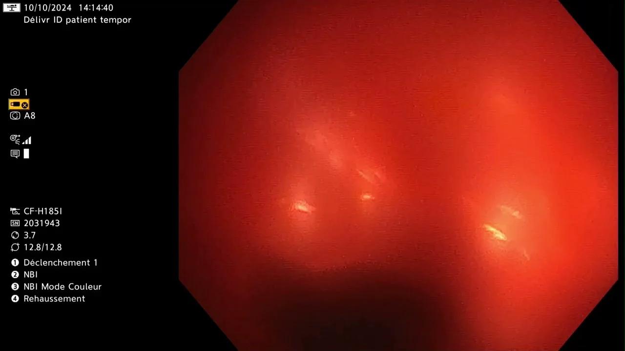 Massive rectal bleeding. Dr Samoi Boudabbous