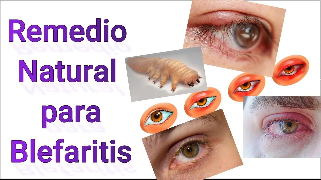 LAS REALES CAUSAS DE LA BLEFARITIS Y ESTOS DOS REMEDIOS NATURALES