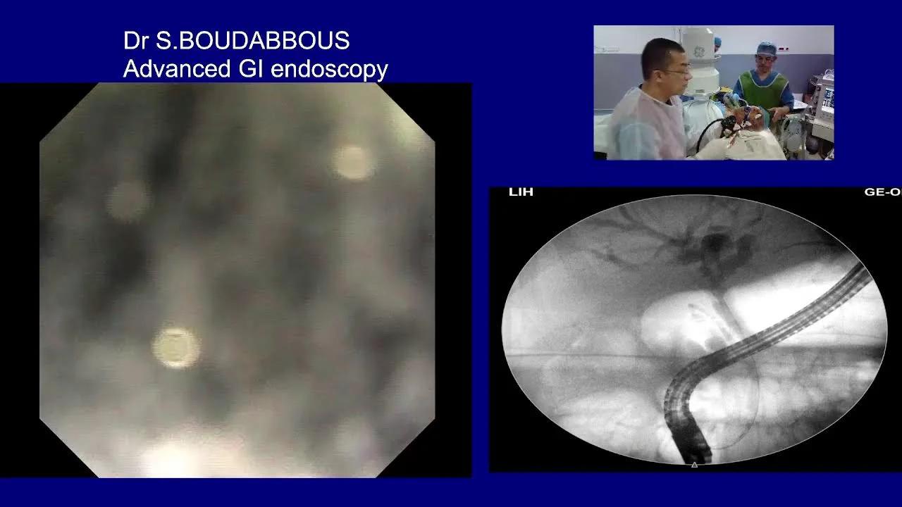 ERCP for acute cholangitis