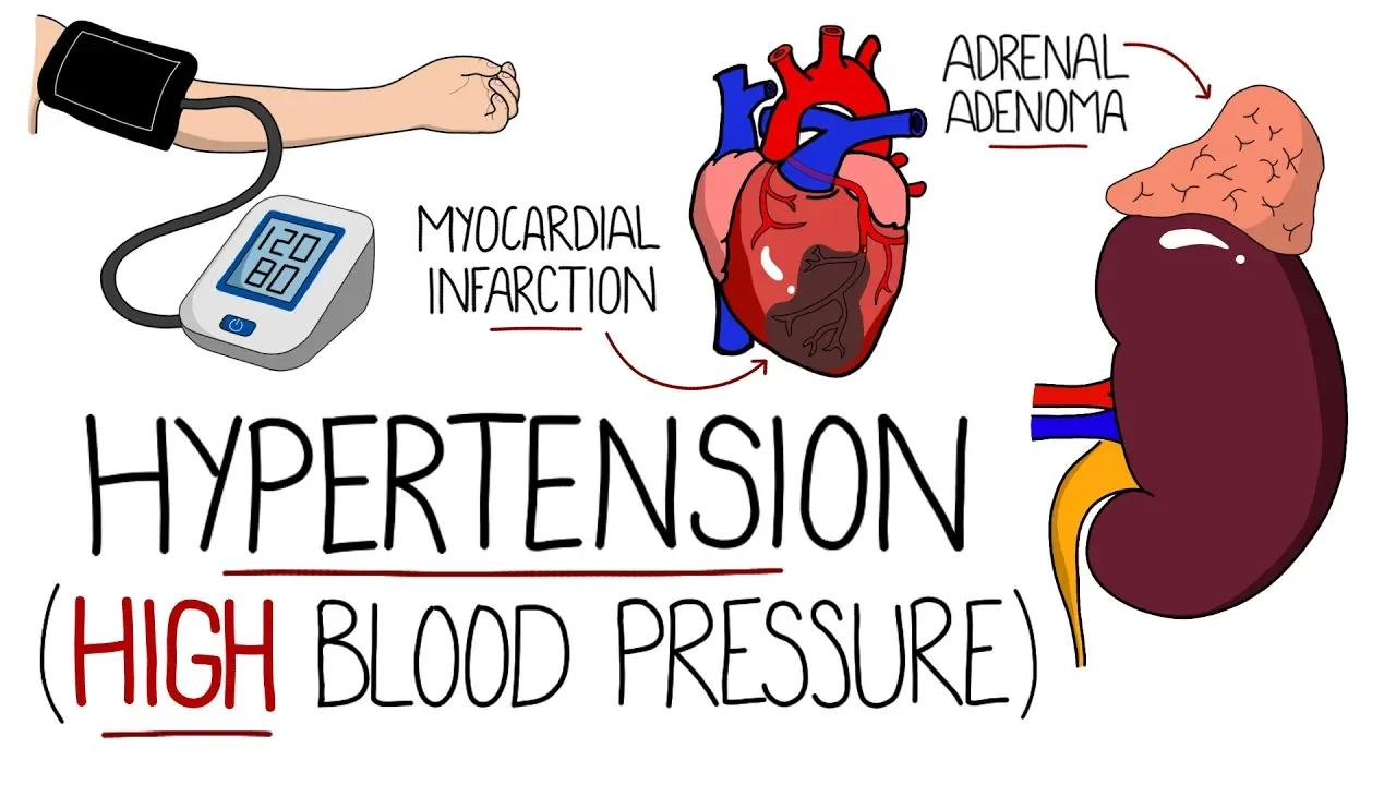 Hypertension Explained (High Blood Pressure) - Includes Hypertensive ...