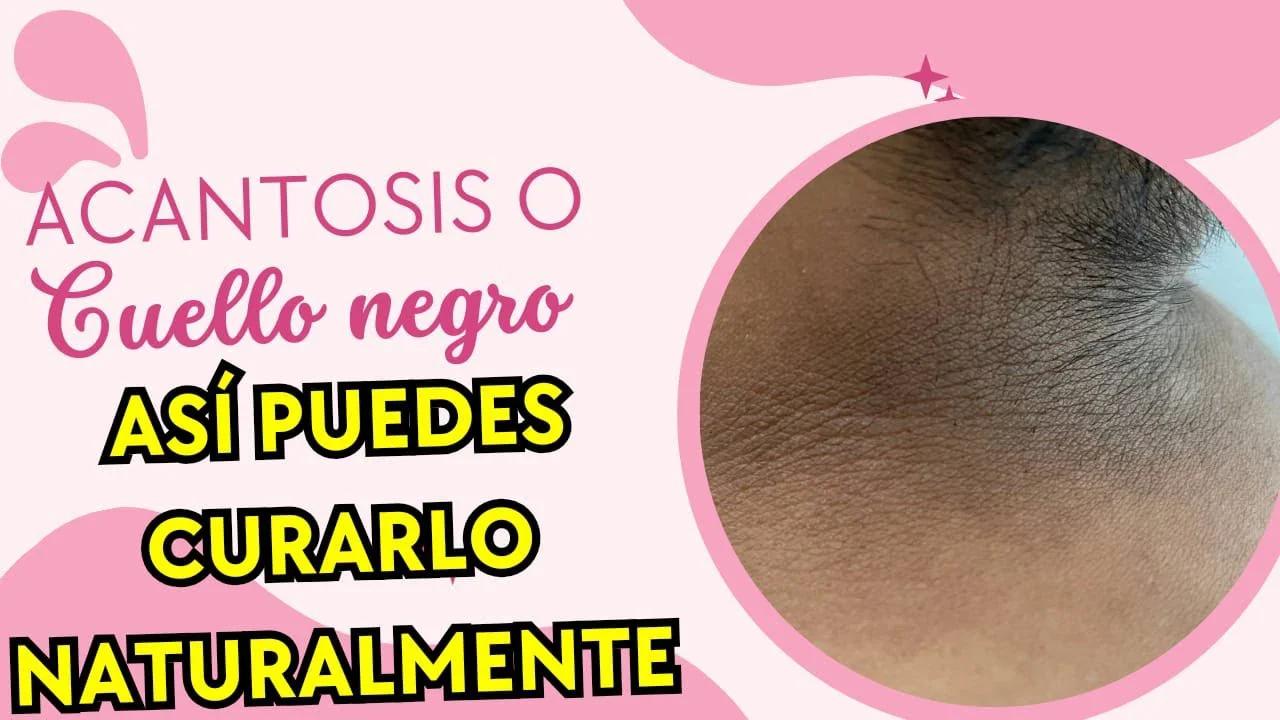 DESCUBRE COMO ELIMINAR EL CUELLO NEGRO NATURALMENTE