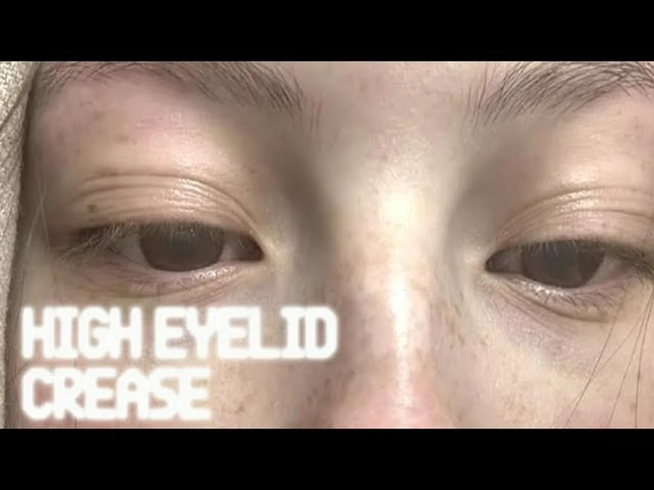 High Eyelid Crease