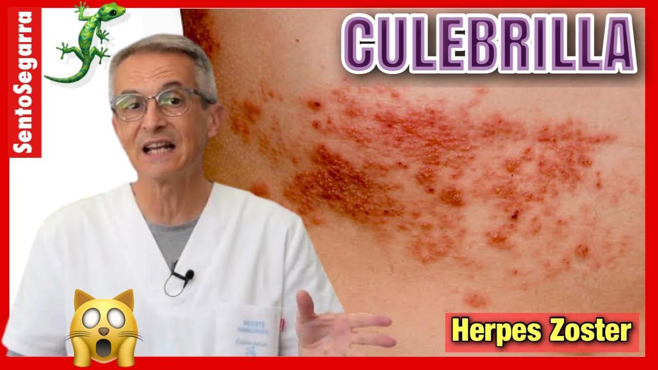 CULEBRILLA 👉 ¿Por qué Hay AHORA más CASOS? ️ [HERPES ZOSTER]