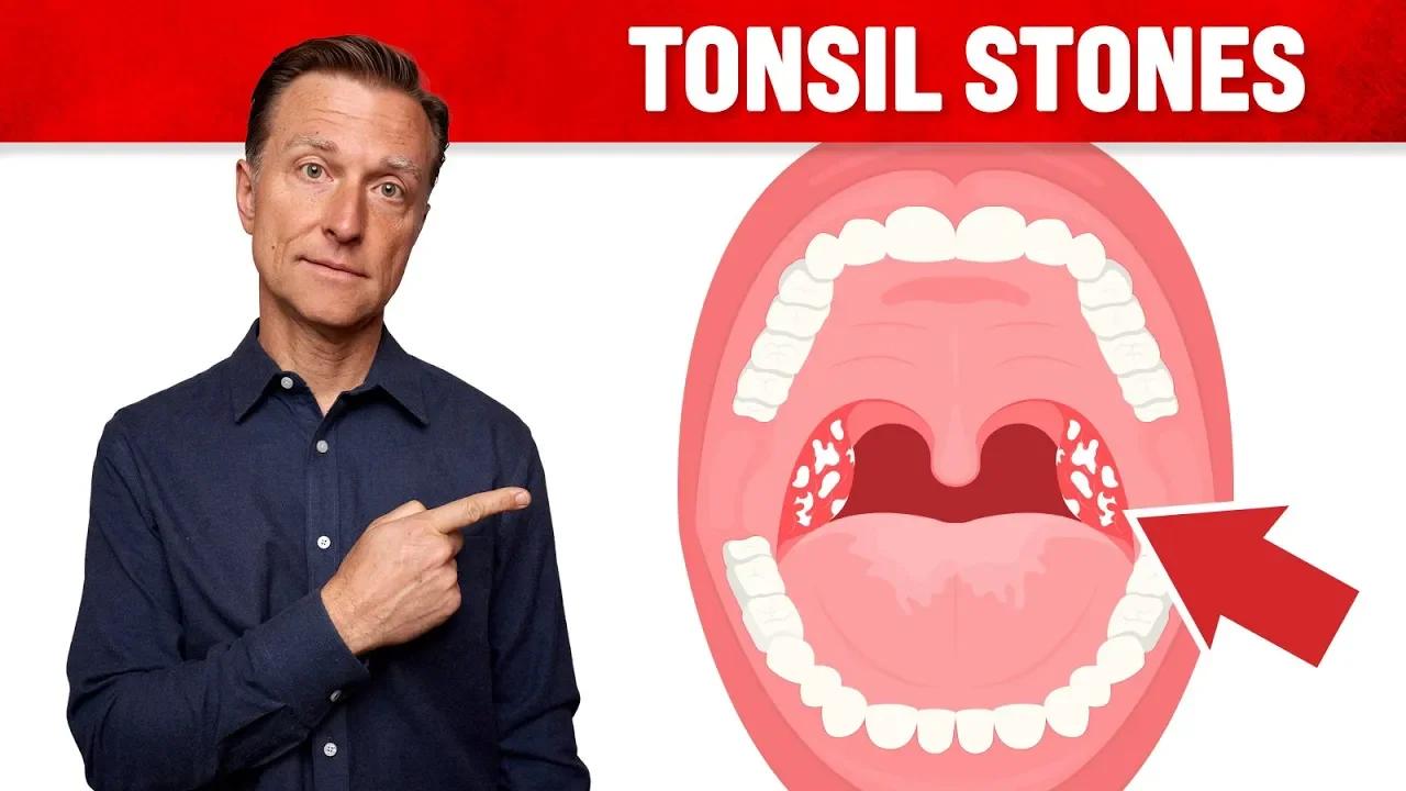 What CAUSES Tonsil Stones and How to Prevent Them