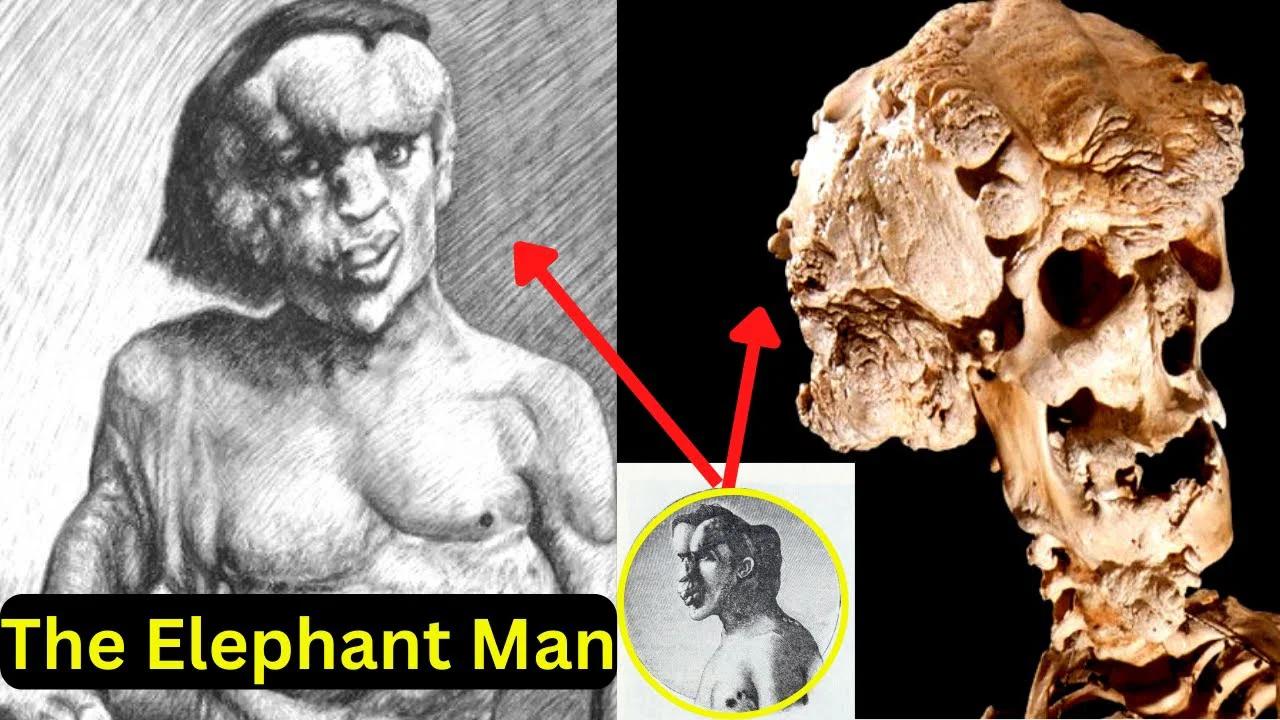 The Elephant Man | The Weird & Tragic Story of Joseph Merrick