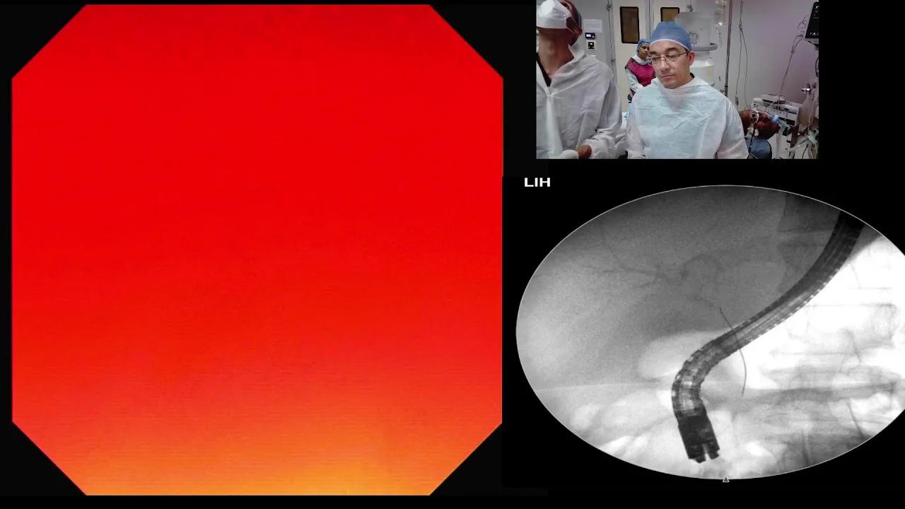 Acute cholangitis with severe sepsis, ERCP for CBD stone