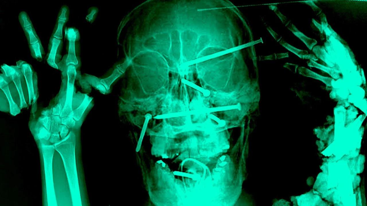 Horrific X-Ray Images With Disturbing Backstories