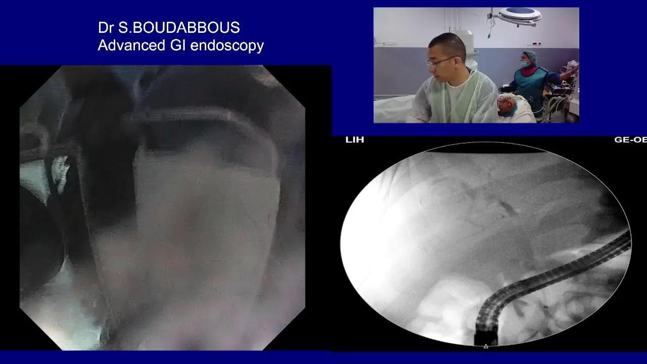 ERCP for acute cholangitis