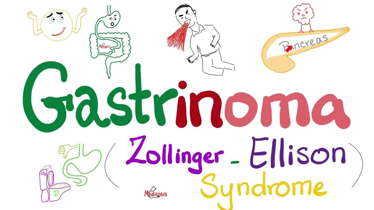 Gastrinoma (Zollinger-Ellison Syndrome or ZES) - Endocrinology and ...