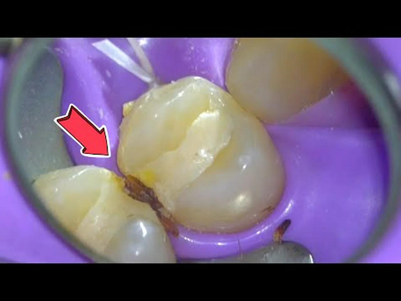 Massive Cavity under Broken Filling (EXPOSED!)