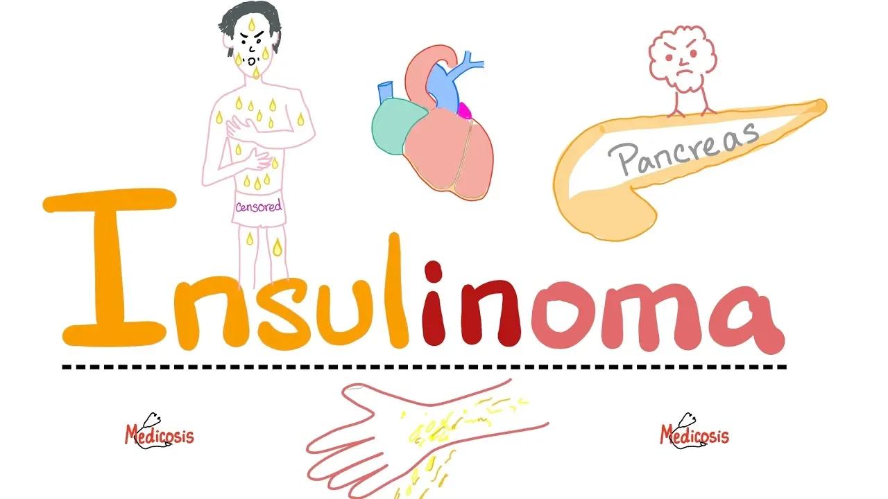 Insulinoma - Insulin-secreting tumor - Endocrine Pathology - Clinical ...