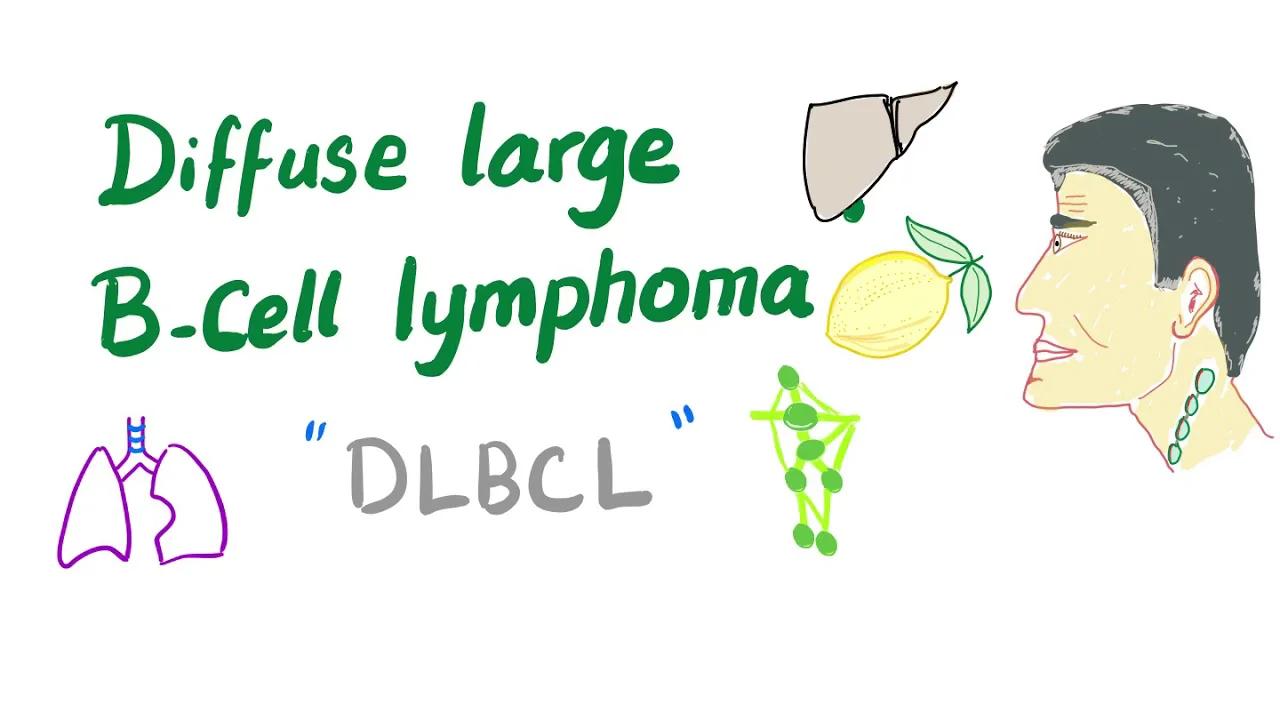 Diffuse Large B-Cell Lymphoma (DLBCL) | Aggressive B-Cell Non-Hodgkin’s ...