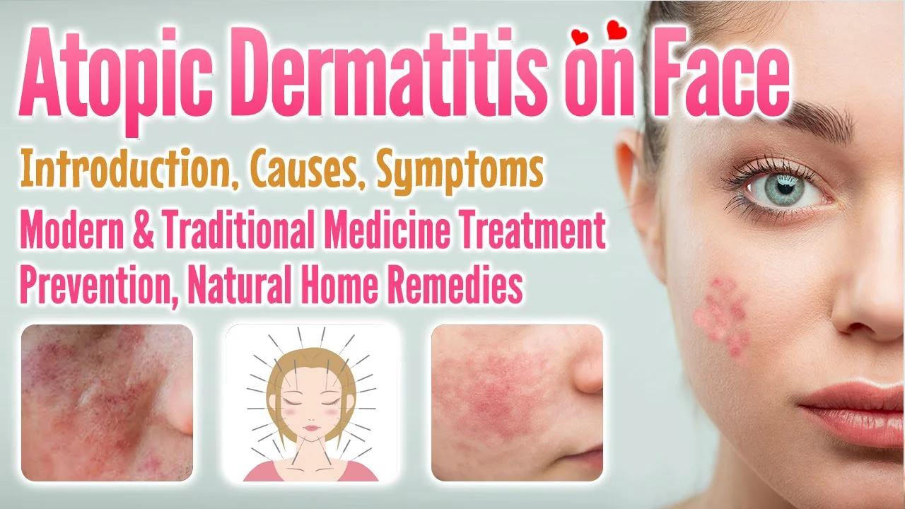 Atopic dermatitis on face causes, symptoms, treatment, prevention, home ...
