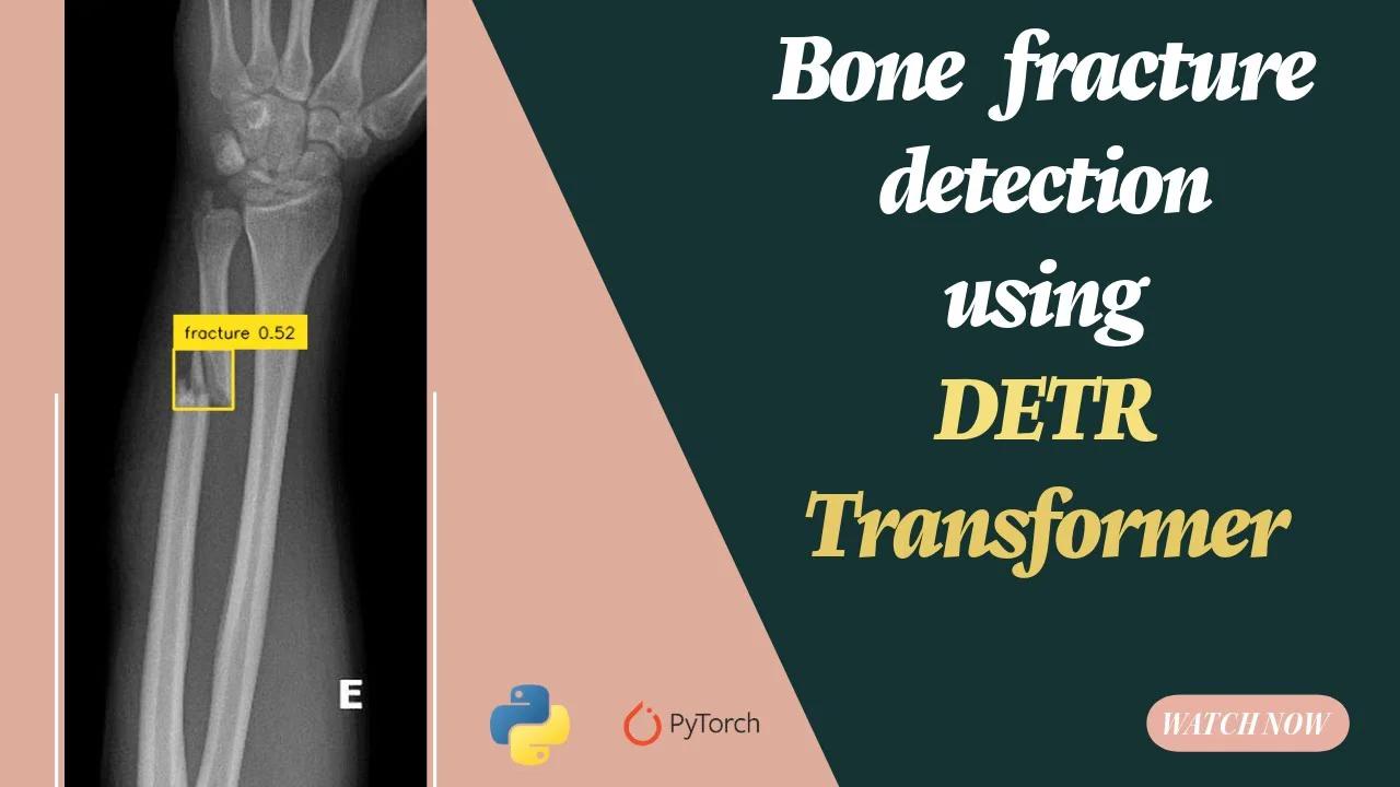 Object Detection Using Detection Transformer Detr For Bone Fraction
