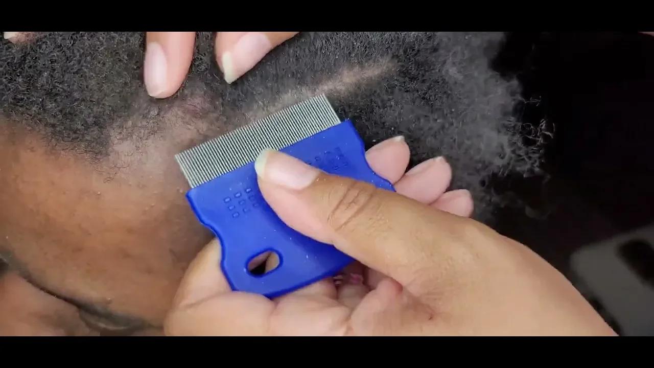 Dandruff Scratching with Comb Finger Nails Massage | Husband's Scalp ...