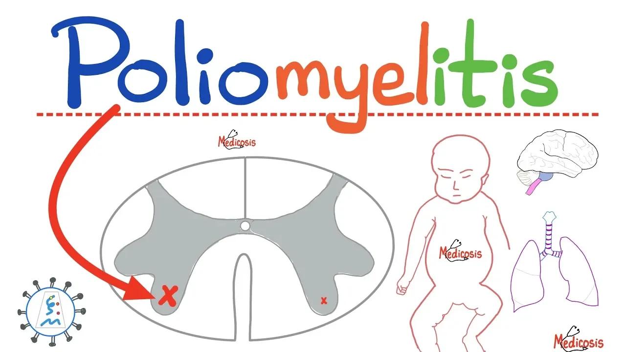 Poliomyelitis - Paralysis - Anterior Horn Cell (AHC) disease- Hypotonia ...