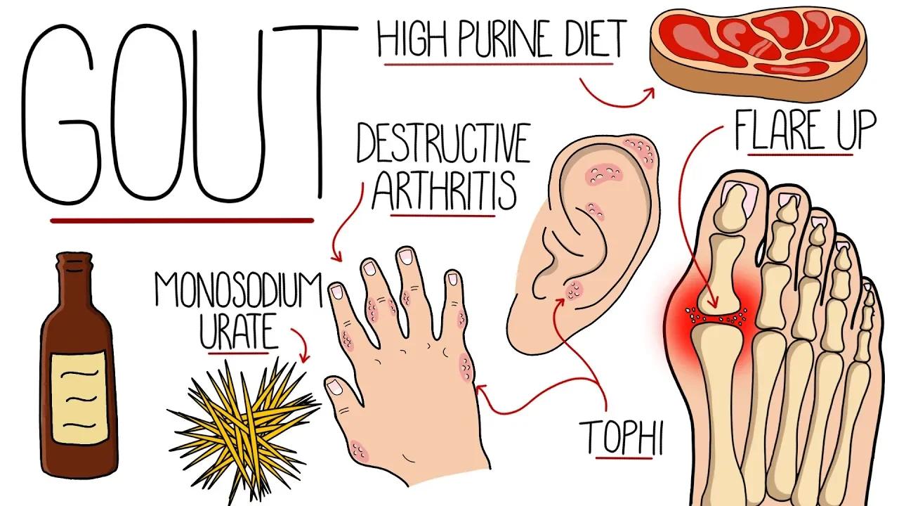 Understanding Gout Explained Clearly
