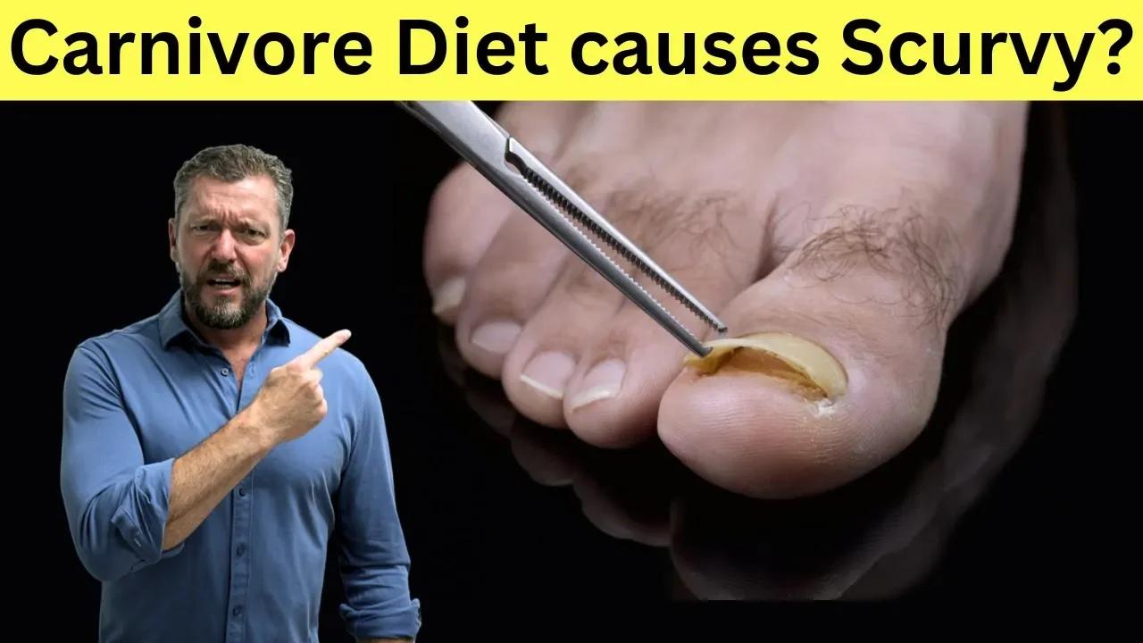 Does the Carnivore Diet cause Scurvy?? [Dietitian vs Doctor]