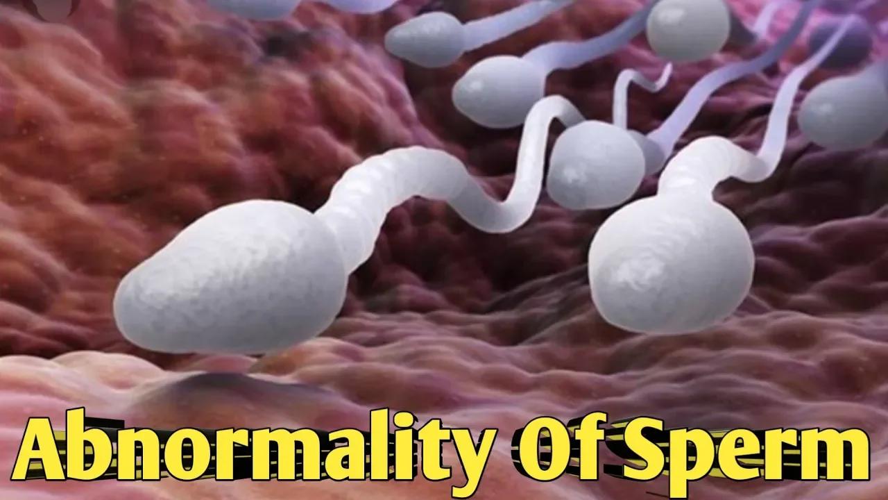 Semen Analysis part -2| Abnormality Of Sperm | Azospermia ...
