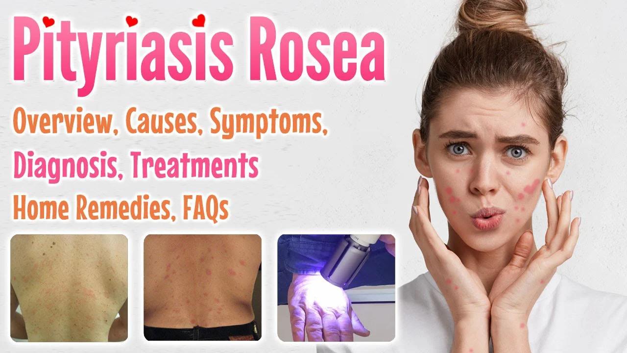 Pityriasis Rosea Overview, Causes, Signs and Symptoms, Diagnosis ...