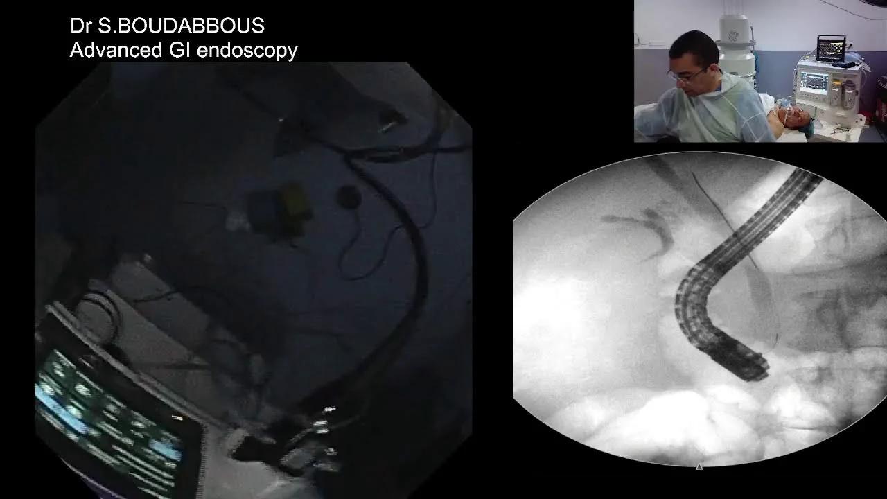 ERCP FOR ACUTE CHOLANGITIS