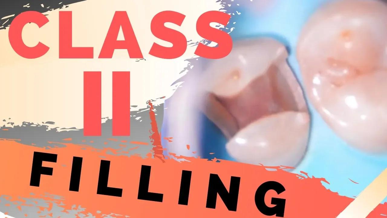 Class II Composite Restoration | LIVE Tooth Filling w/ MICROSCOPE