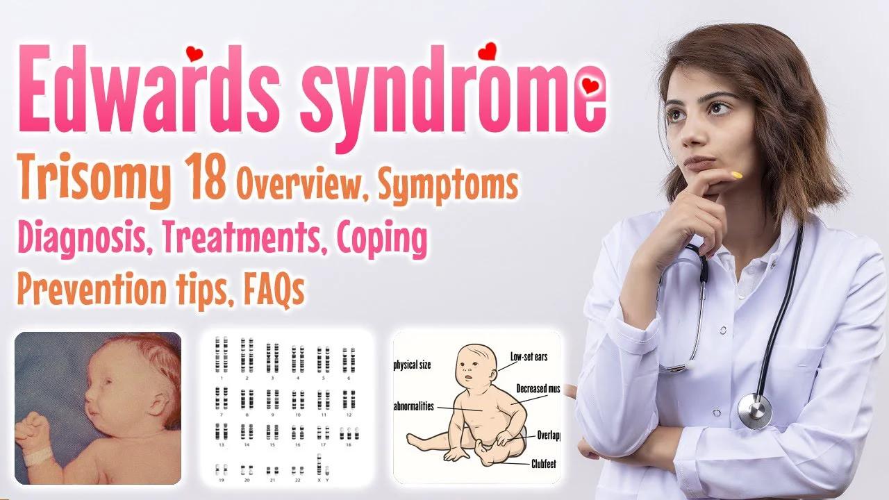 Edwards syndrome trisomy 18 causes, symptoms, diagnosis, treatment ...