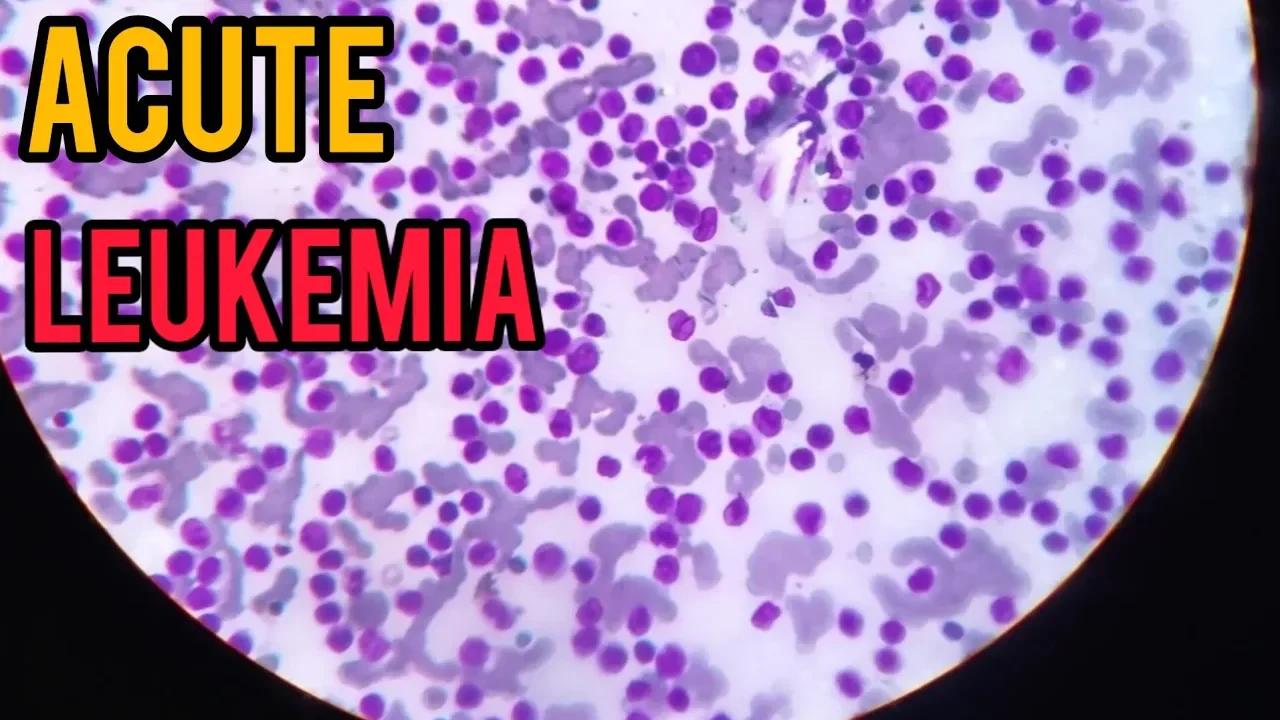Acute Leukemia in High power field || Blood Cancer Slide