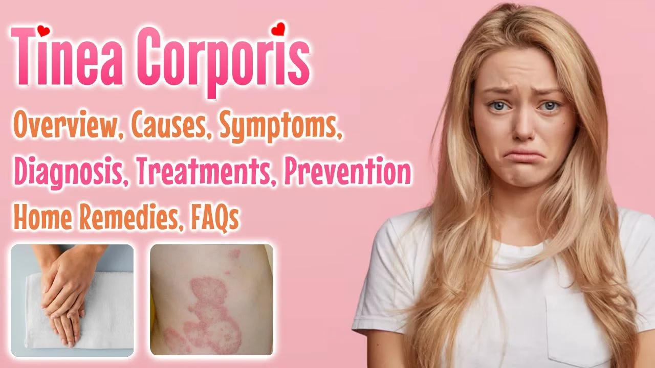 Tinea corporis overview, causes, sign and symptoms, diagnosis ...