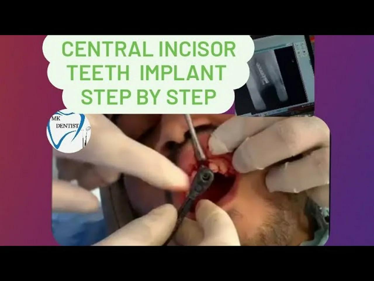 Central incisor teeth implant #viral #video #Dental implants