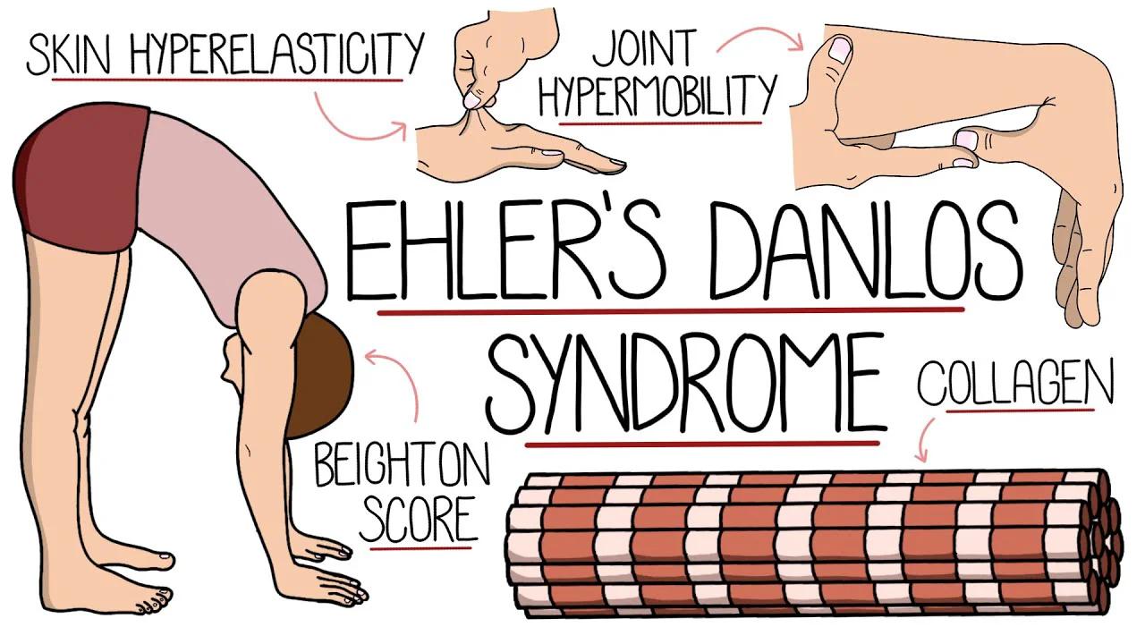 Ehler's Danlos Syndrome Explained Clearly