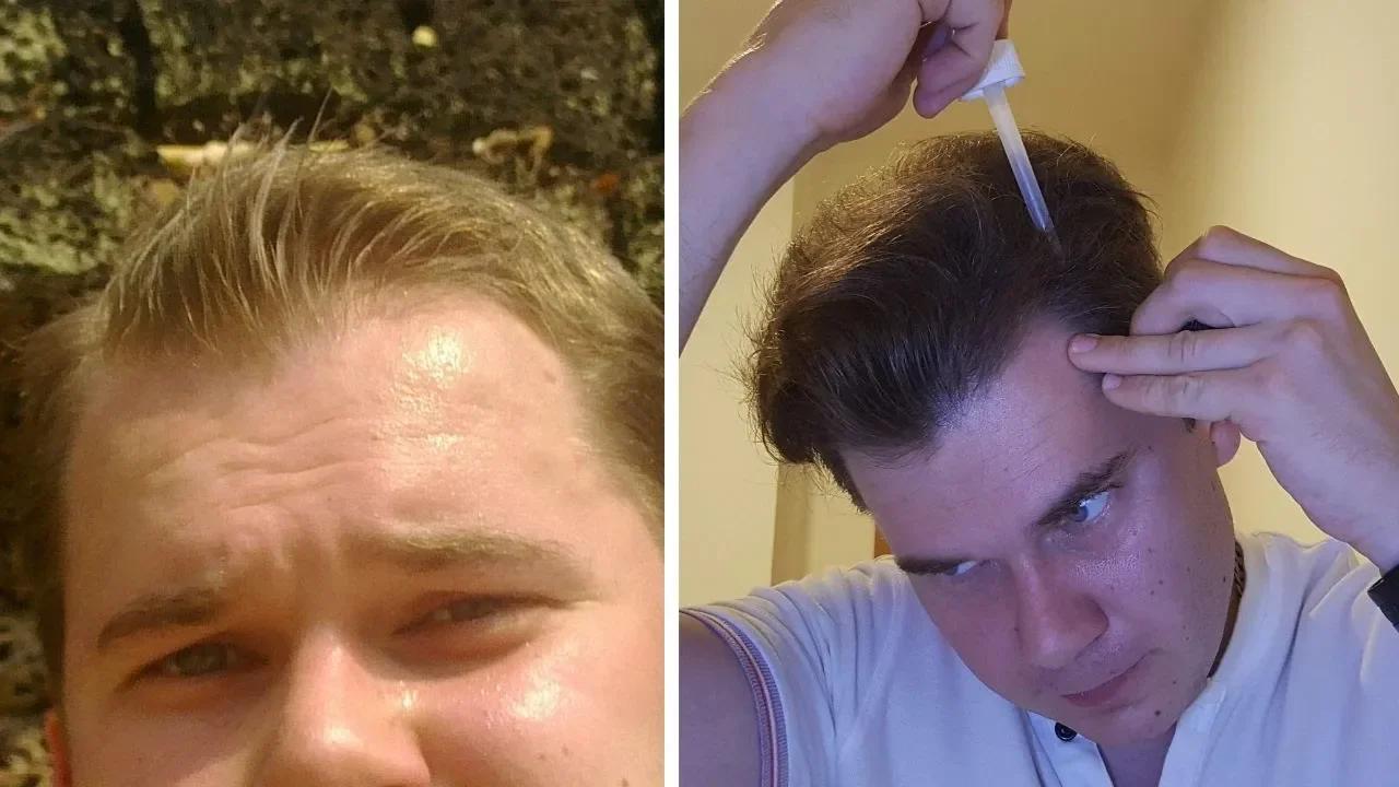 Hair Loss Treatment Regrowth Timeline How Long It Takes