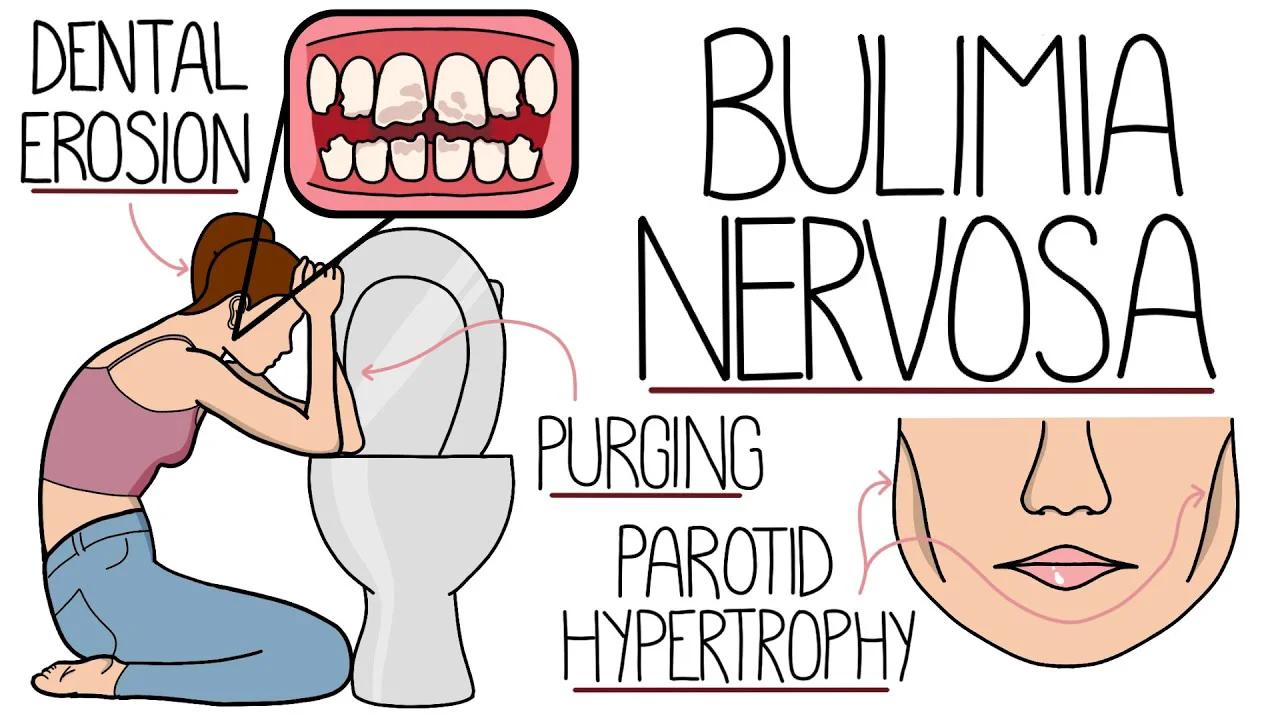 Understanding Bulimia (Bulimia Nervosa Explained Clearly)