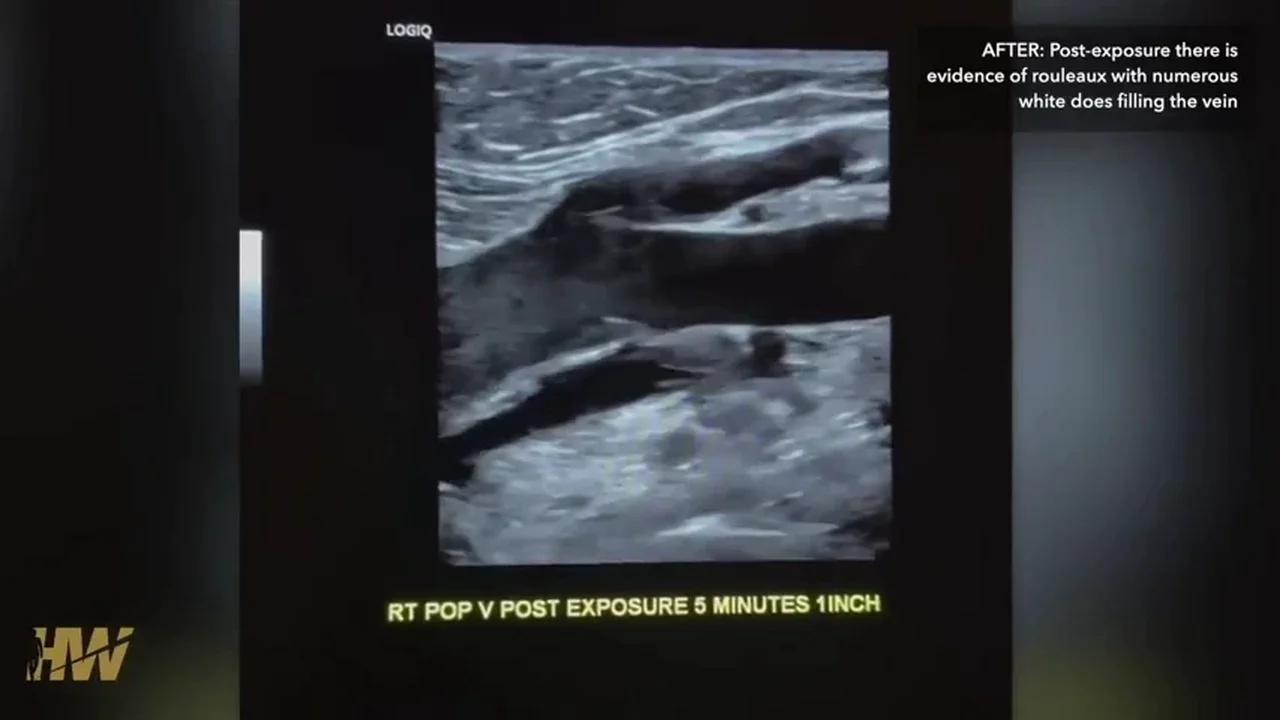 BLOOD CLOTS IN 5 MINUTES - CELL PHONE RADIATION UNDER THE MICROSCOPE