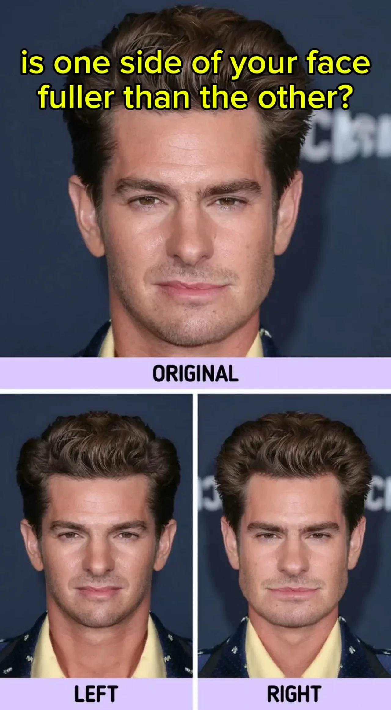 Fixing Asymmetrical Face - Lateral Strain - Orthotropic Technique